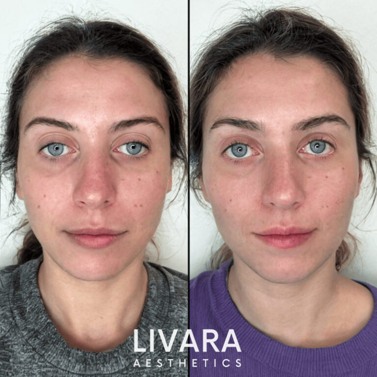 Tear Trough Fillers: Pros & Cons - Everything You Need to Know - Livara ...