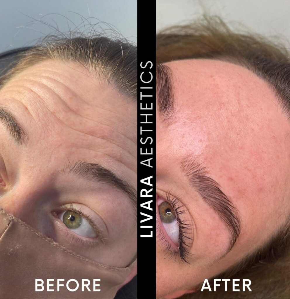 Anti Wrinkle - Livara Aesthetics