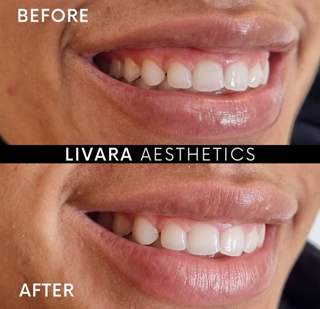 Gummy Smile - Livara Aesthetics