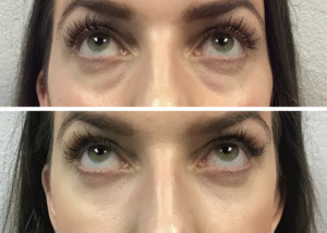 Tear Trough Fillers: Pros & Cons - Everything You Need to Know - Livara ...
