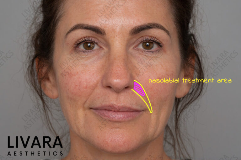 Nasolabial Folds Treatment: Causes & Filler Options